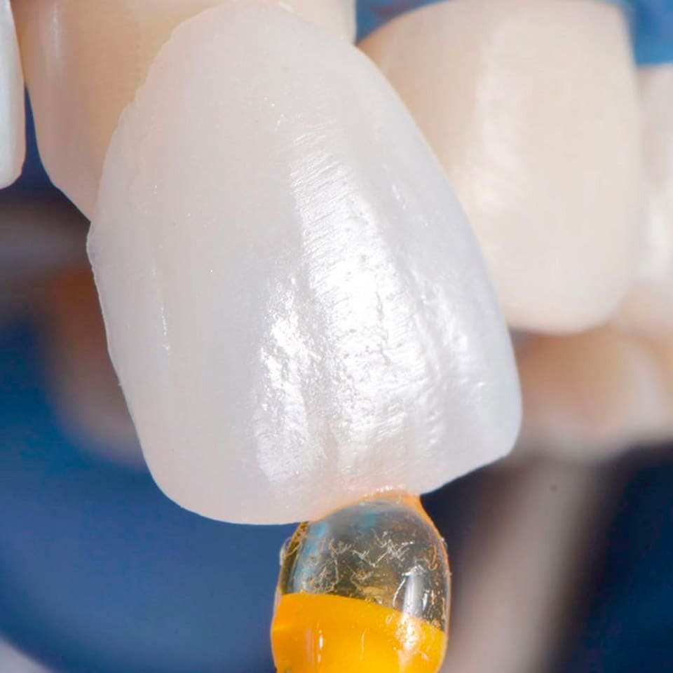 E-Max Veneer - Prime Dent Istanbul